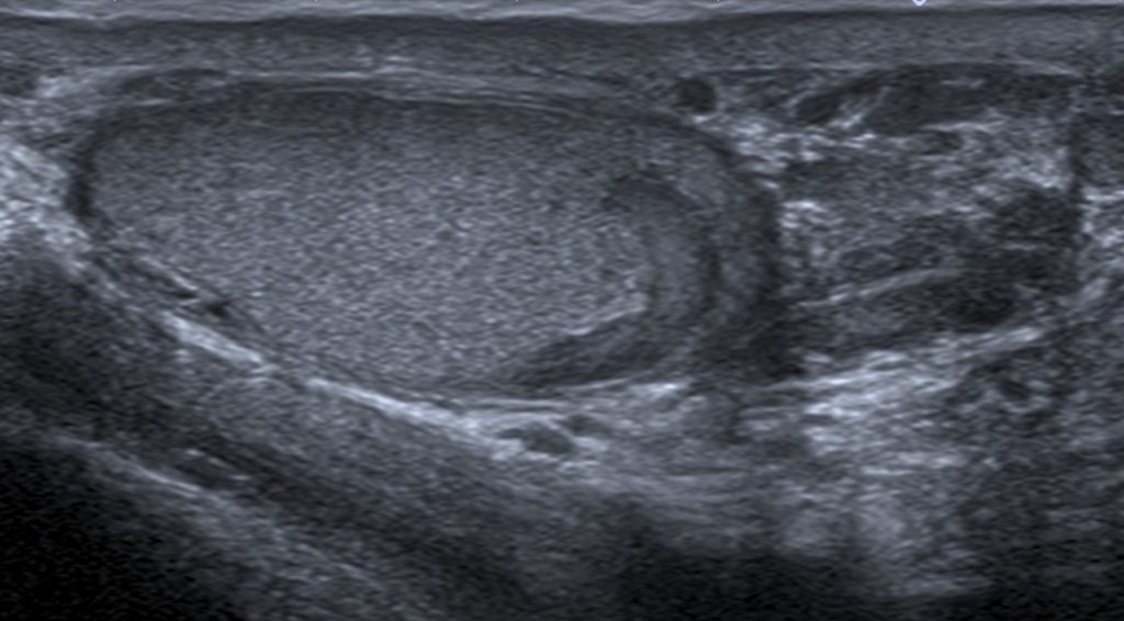 VARICOCELE INTRATESTICULAR - Clínica Regina Pastor