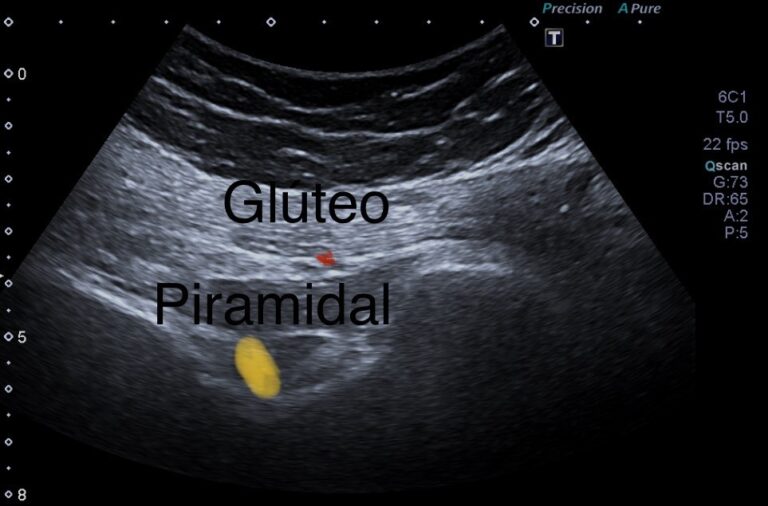 Diagnóstico y tratamiento del síndrome del piramidal. - Clínica Regina ...